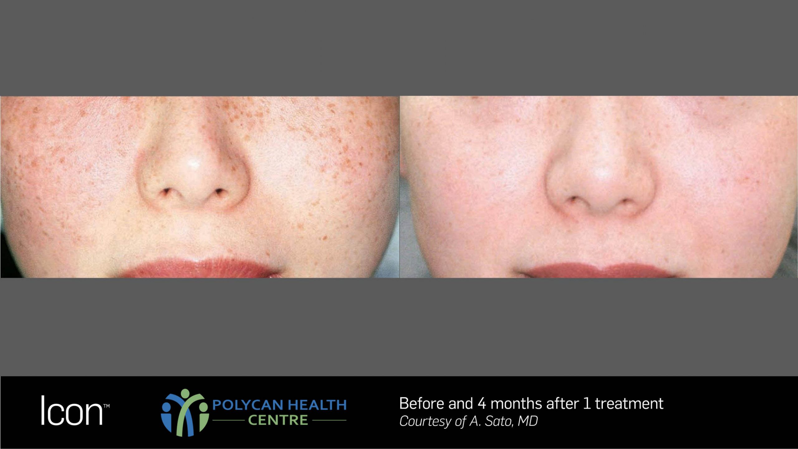 Skin Revitalization - PolyCan Health Centre